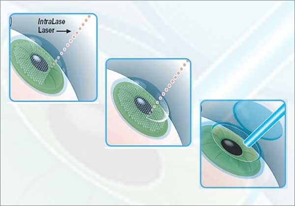 Bladeless Lasik Surgery in Delhi - Visual Aids Centre