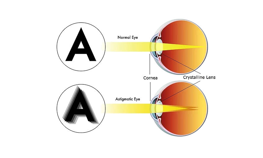 Can LASIK Cure Astigmatism? - Visual Aids Centre