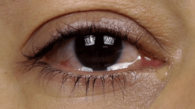 Dry Eyes Treatment - Visual Aids Centre - Lasik Eye Surgery In Delhi