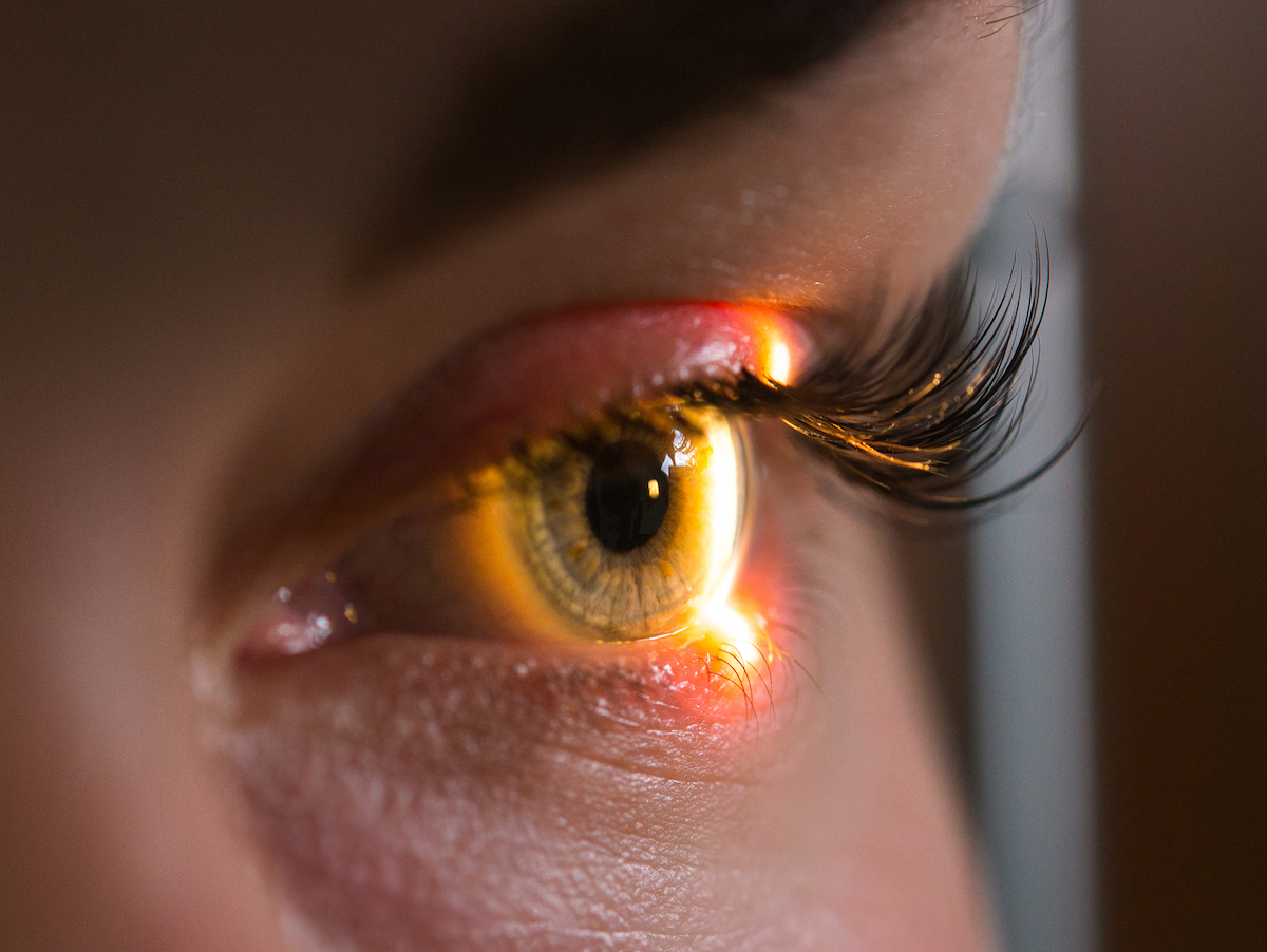 Can You Wear Contacts After Smile Pro Eye Surgery?