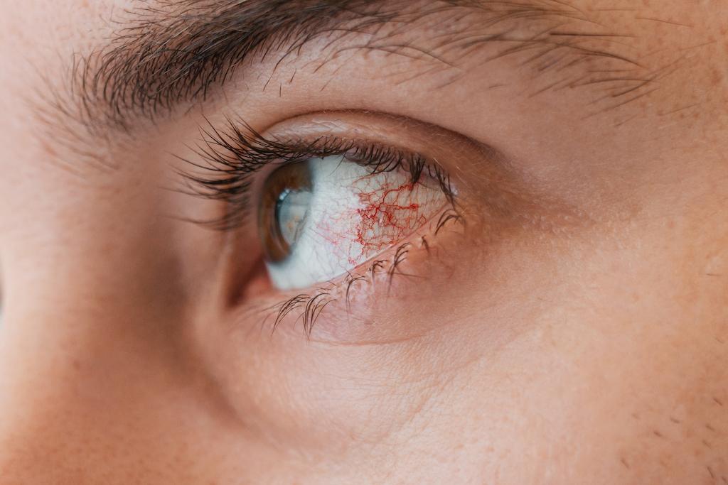 Does the Cornea Heal After Smile Pro Eye Surgery?