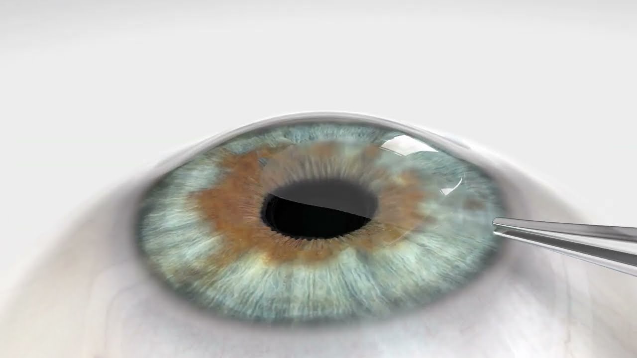 Does Smile Pro Surgery Reshape the Cornea?