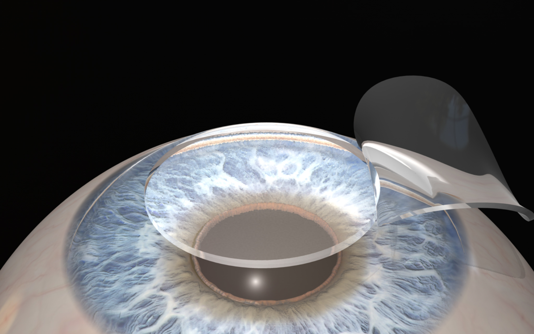 What Happens If Lasik Flap Is Lost?