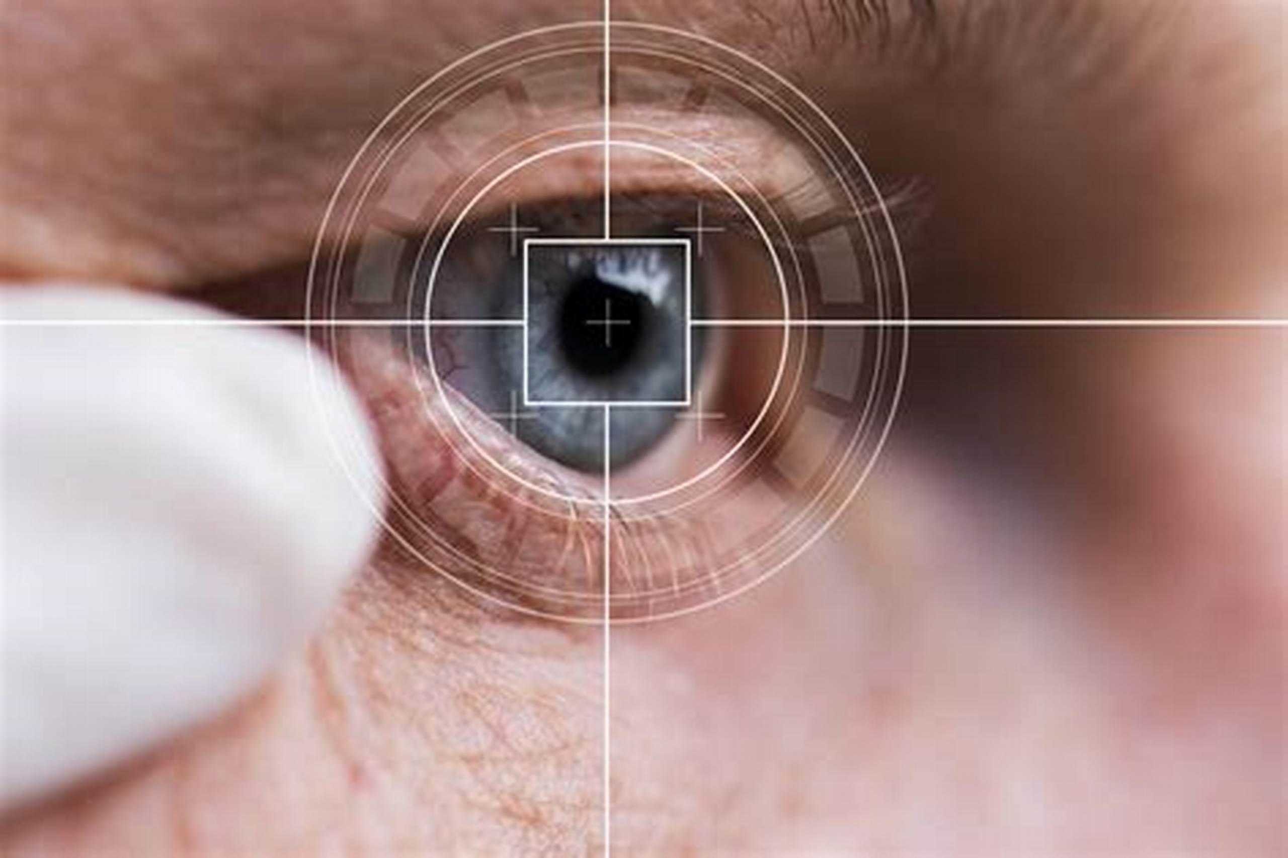 Flap Striae After Lasik?