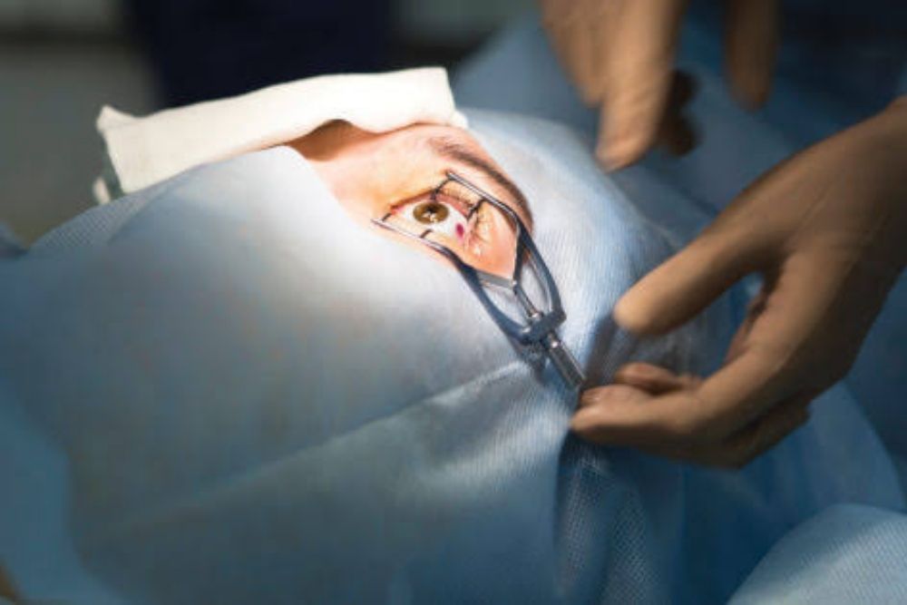 How Do I Know If My Lasik Flap Moved?