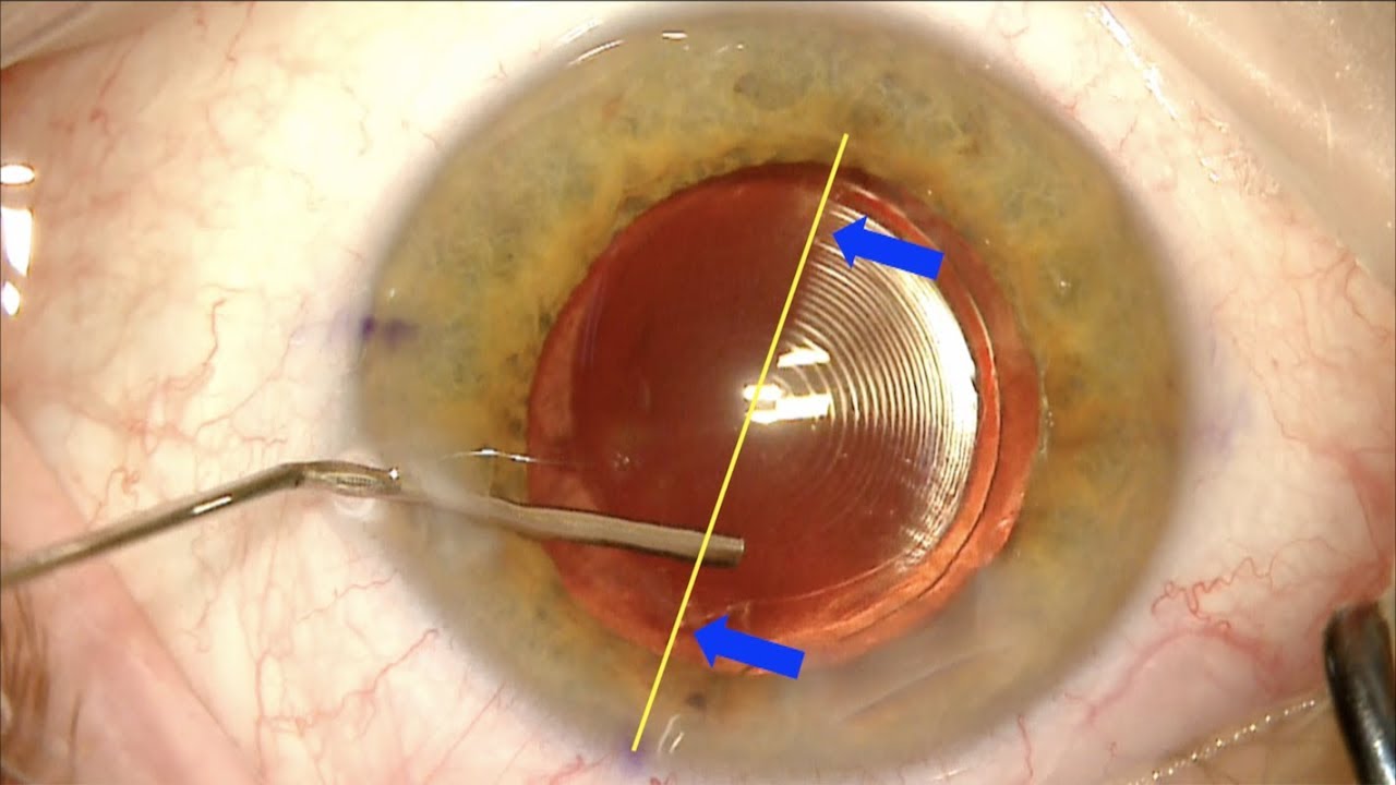 Multifocal Iol After Lasik?