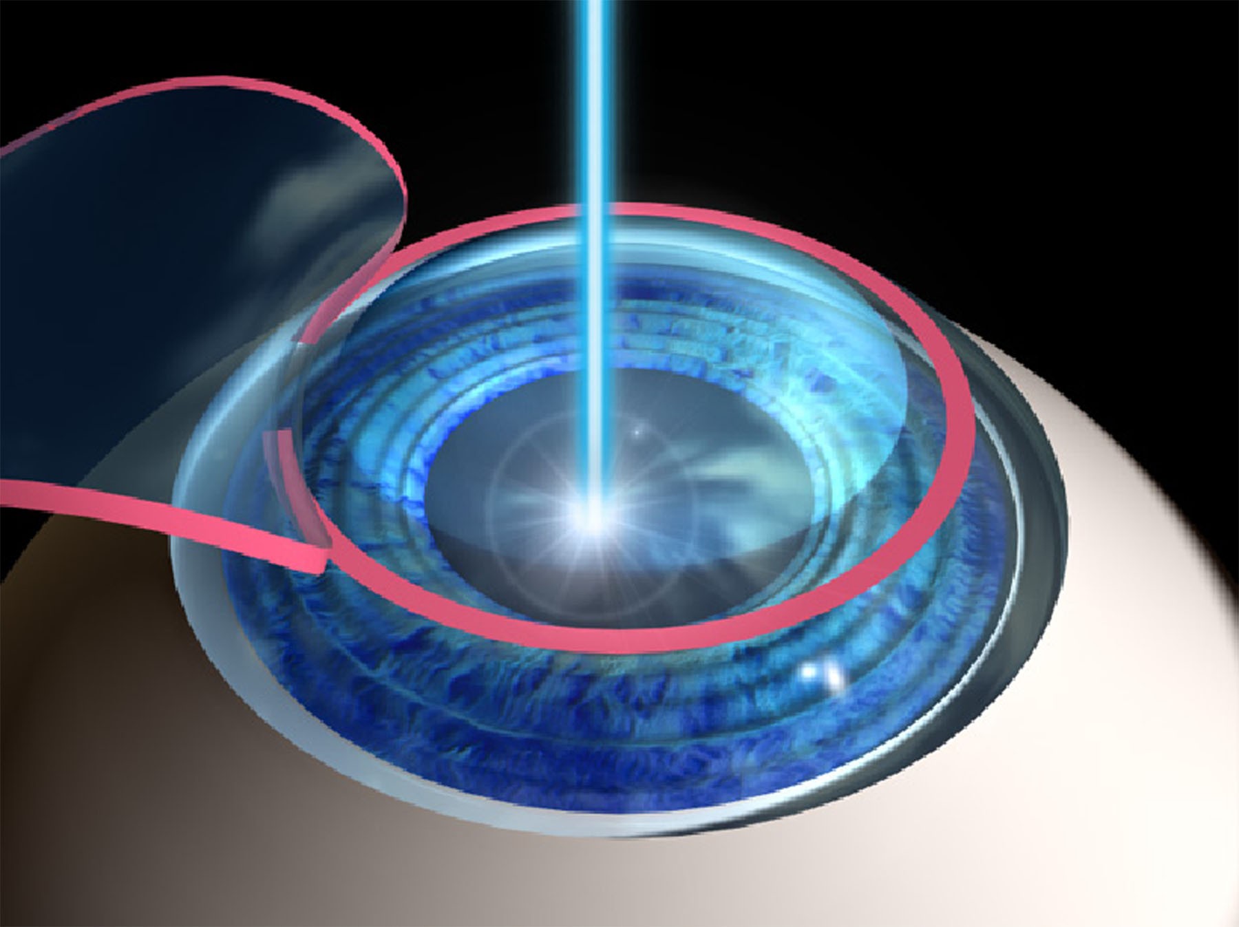 Can You Have Lasik More Than Once? - Visual Aids Centre - Lasik Eye ...