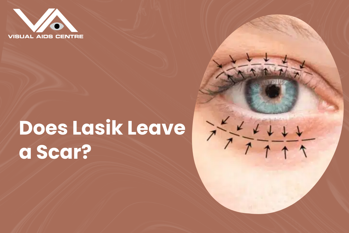 Does Lasik Leave a Scar?