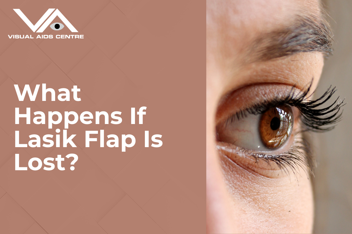 What Happens If Lasik Flap Is Lost?