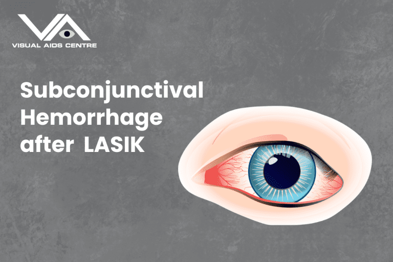 Subconjunctival Hemorrhage After Lasik