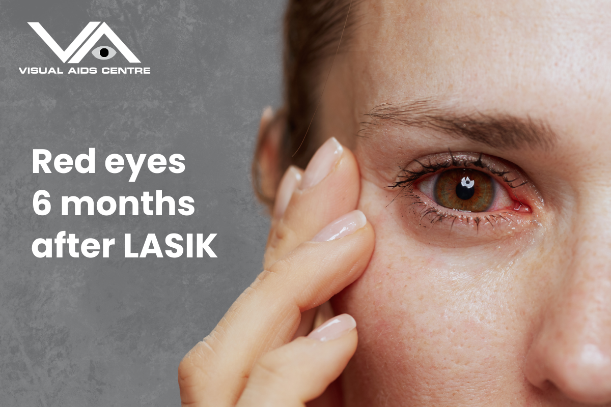 Red Eyes 6 Months After LASIK