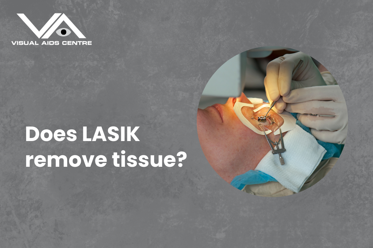 Does LASIK Remove Tissue?