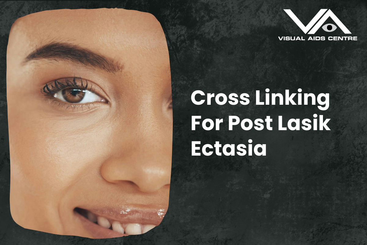 Cross Linking For Post Lasik Ectasia?