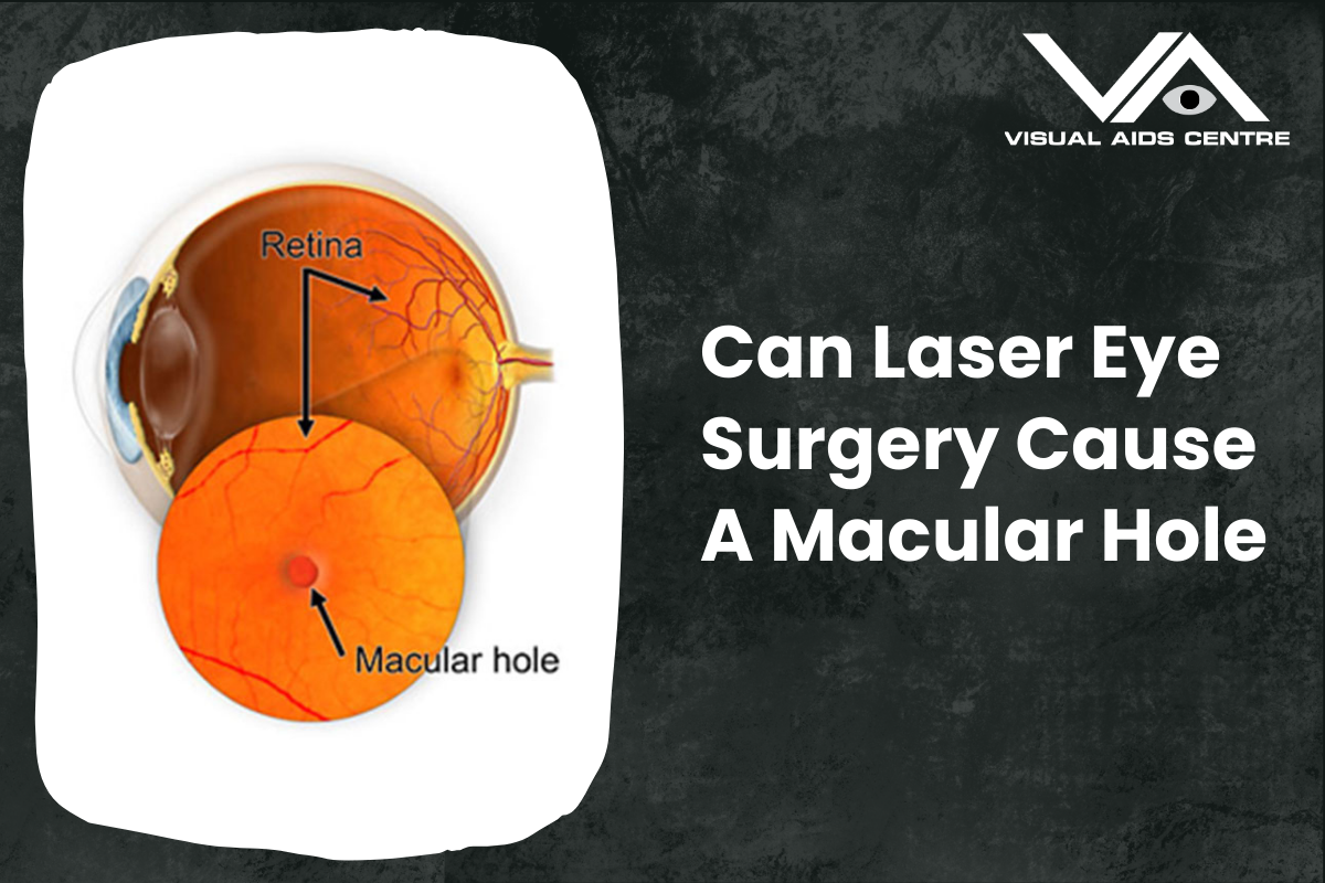 Can Laser Eye Surgery Cause A Macular Hole
