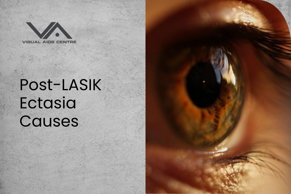 Understanding Post-LASIK Ectasia: Causes and Risks
