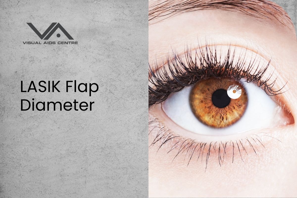 Lasik Flap Diameter: What You Need to Know