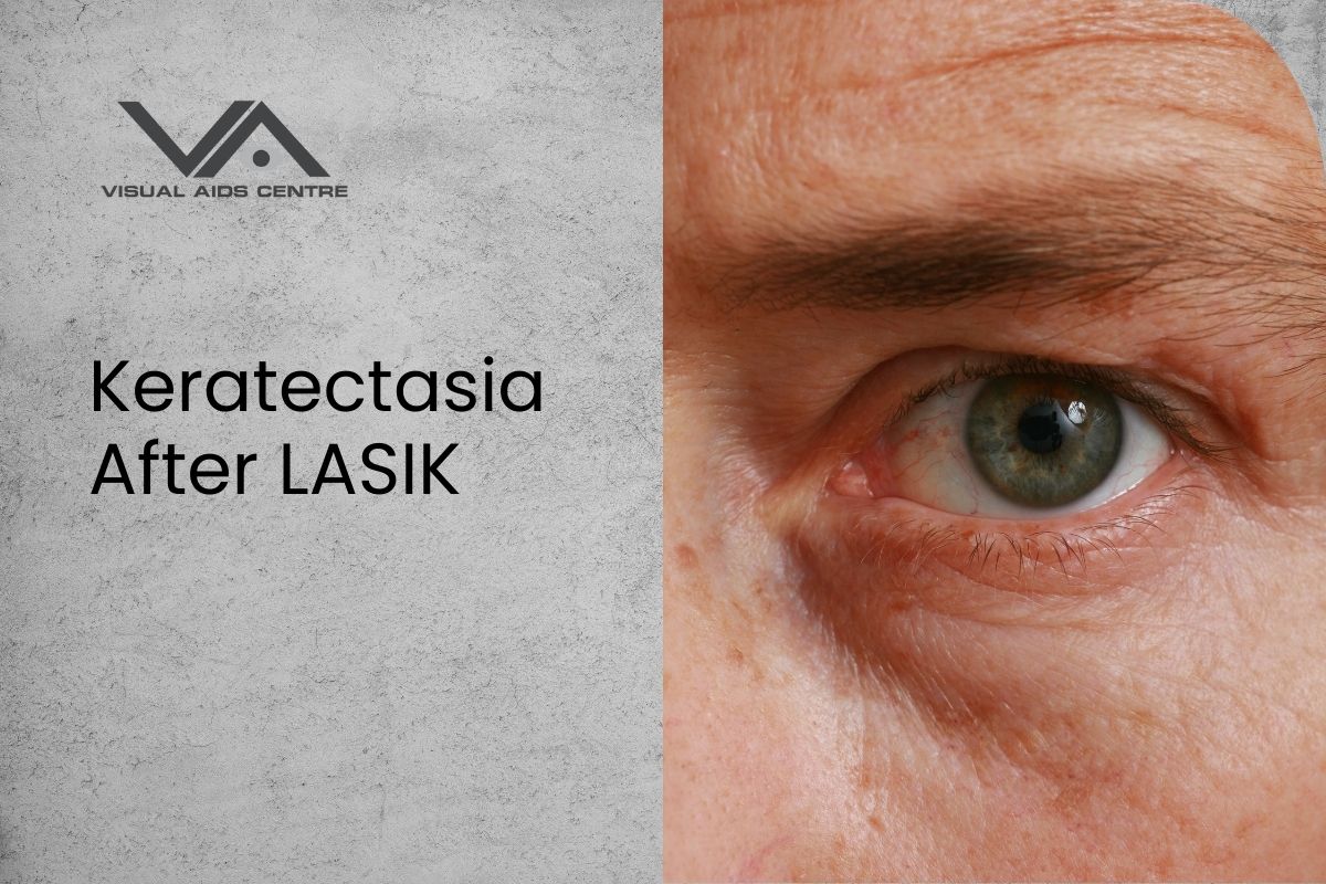 Keratectasia After Lasik: What You Need to Know
