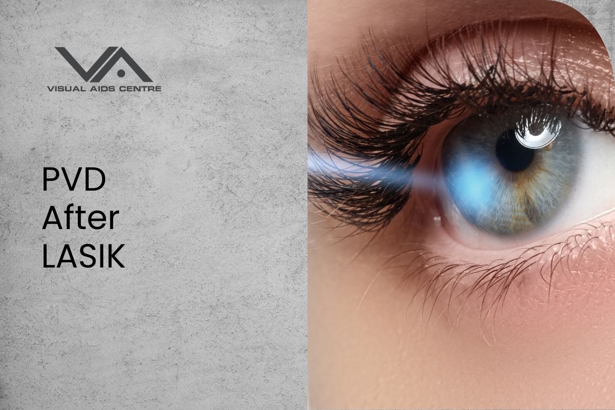 Understanding Posterior Vitreous Detachment (PVD) After LASIK - Visual Aids Centre