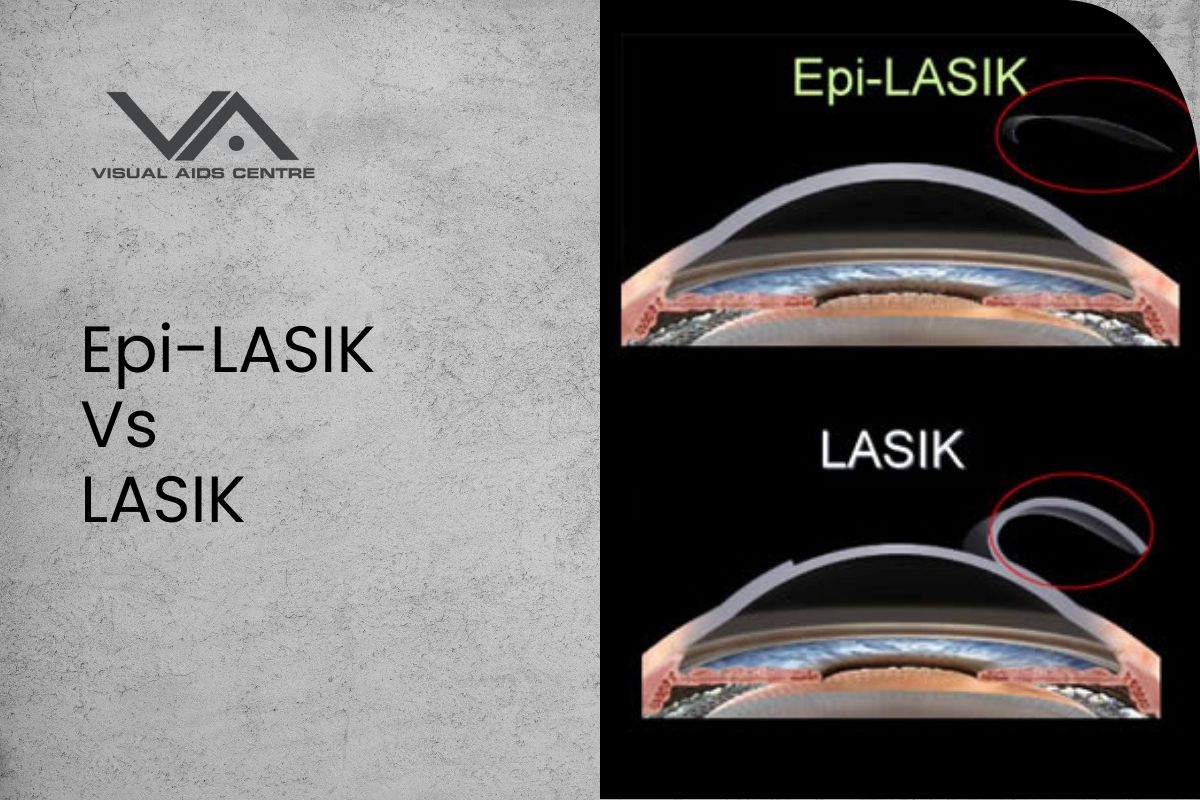 Epi-lasik Vs Lasik - Visual Aids Centre - Lasik Eye Surgery In Delhi