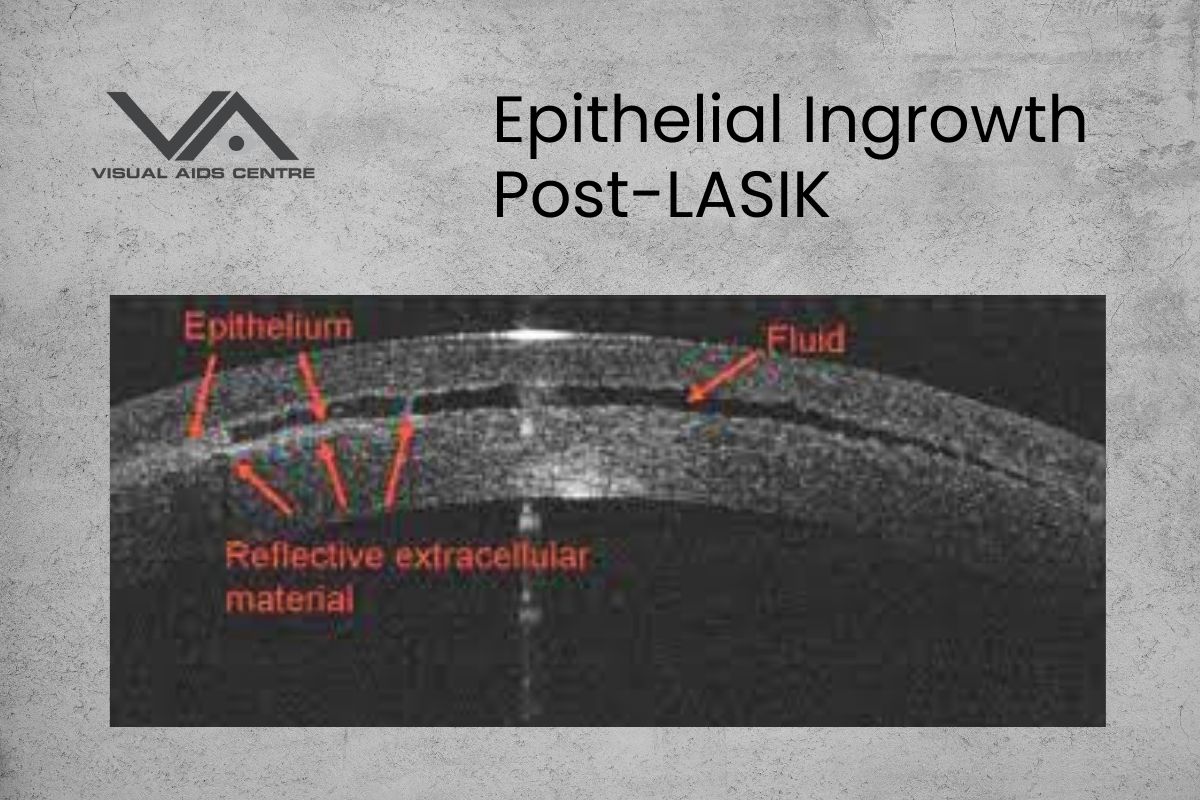 Epithelial Ingrowth Post LASIK - Visual Aids Centre