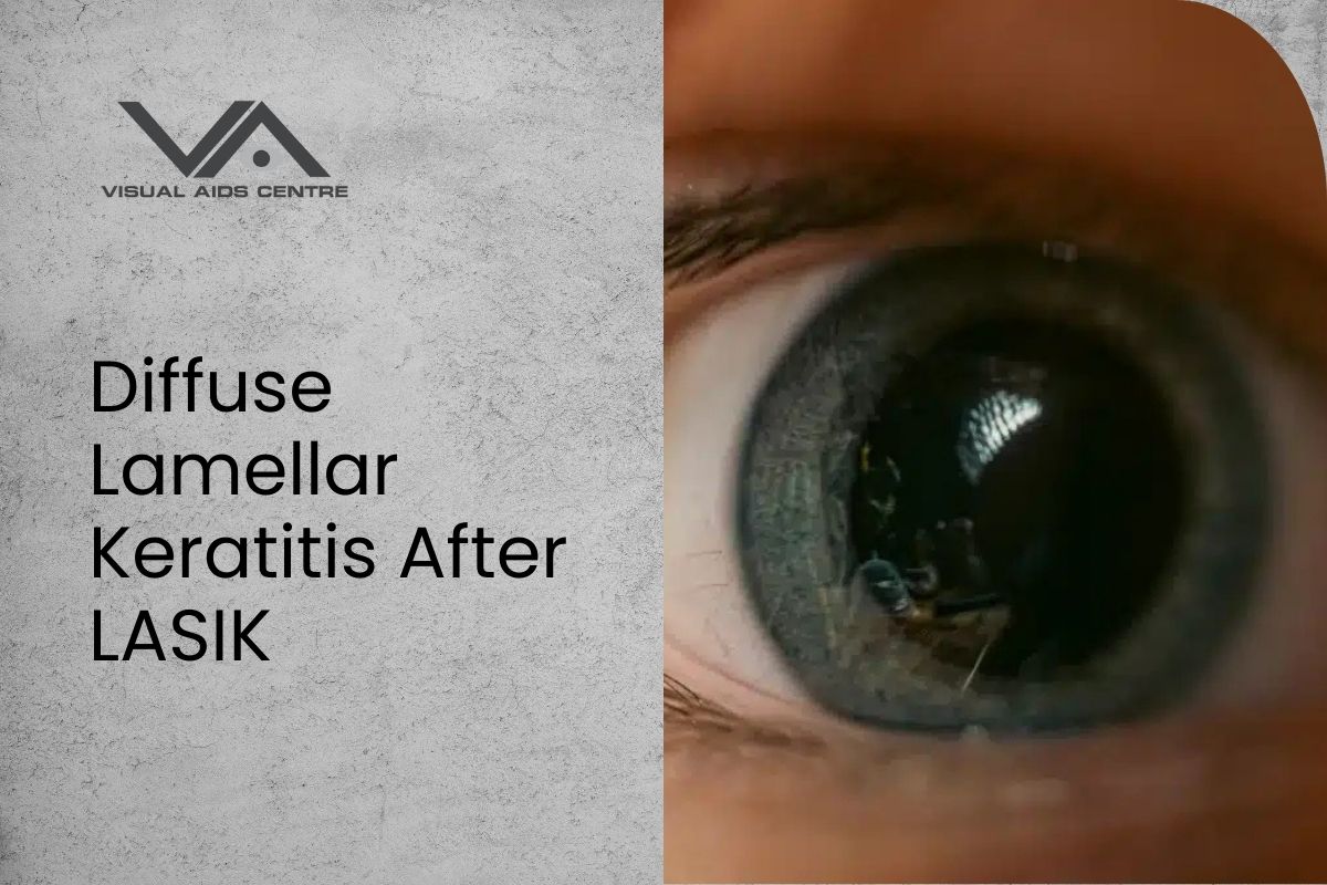 Diffuse Lamellar Keratitis After LASIK: What You Need to Know - Visual ...
