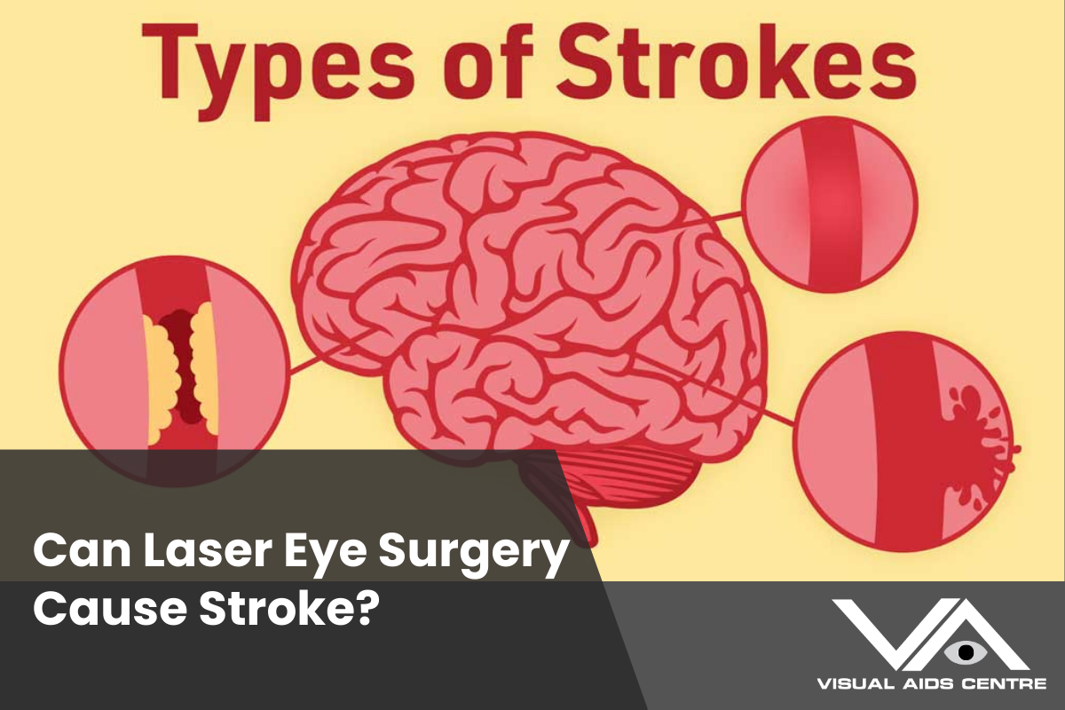 Can Laser Eye Surgery Cause Stroke? Understanding the Risks