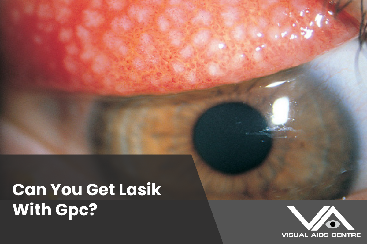 Can You Get LASIK With GPC? What You Need to Know