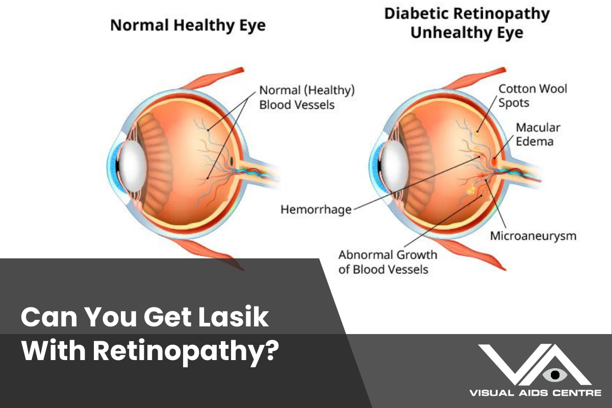 Can You Get LASIK With Retinopathy? Key Considerations