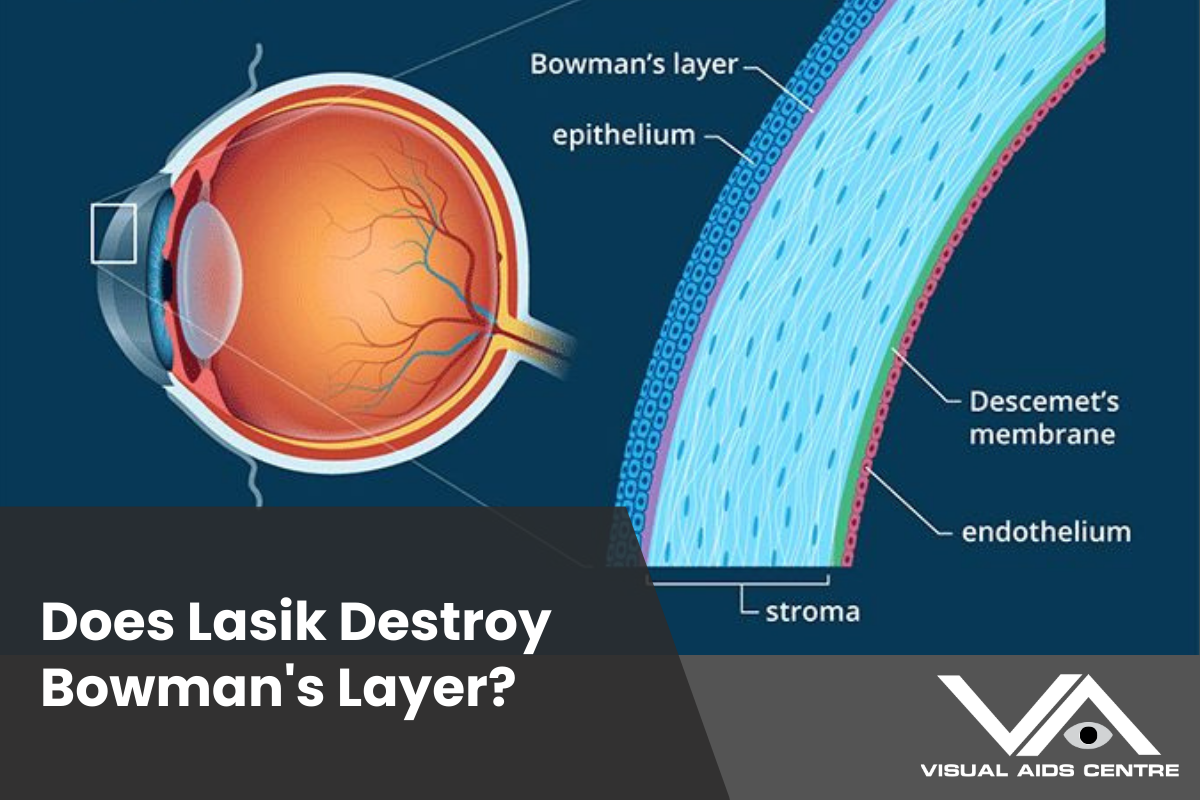Does LASIK Destroy Bowman's Layer? Understanding the Impact